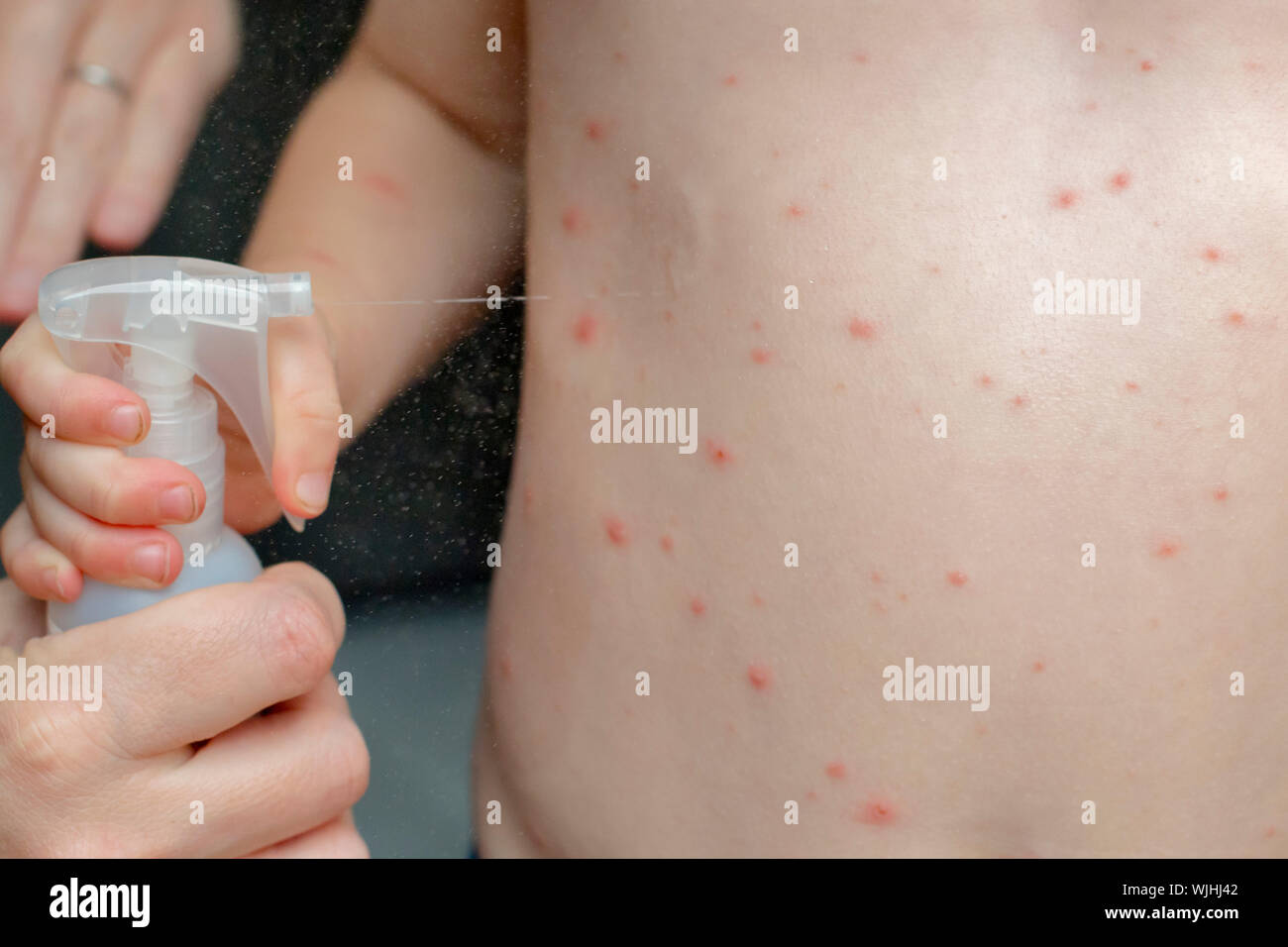 Scab scar hi-res stock photography and images - Alamy