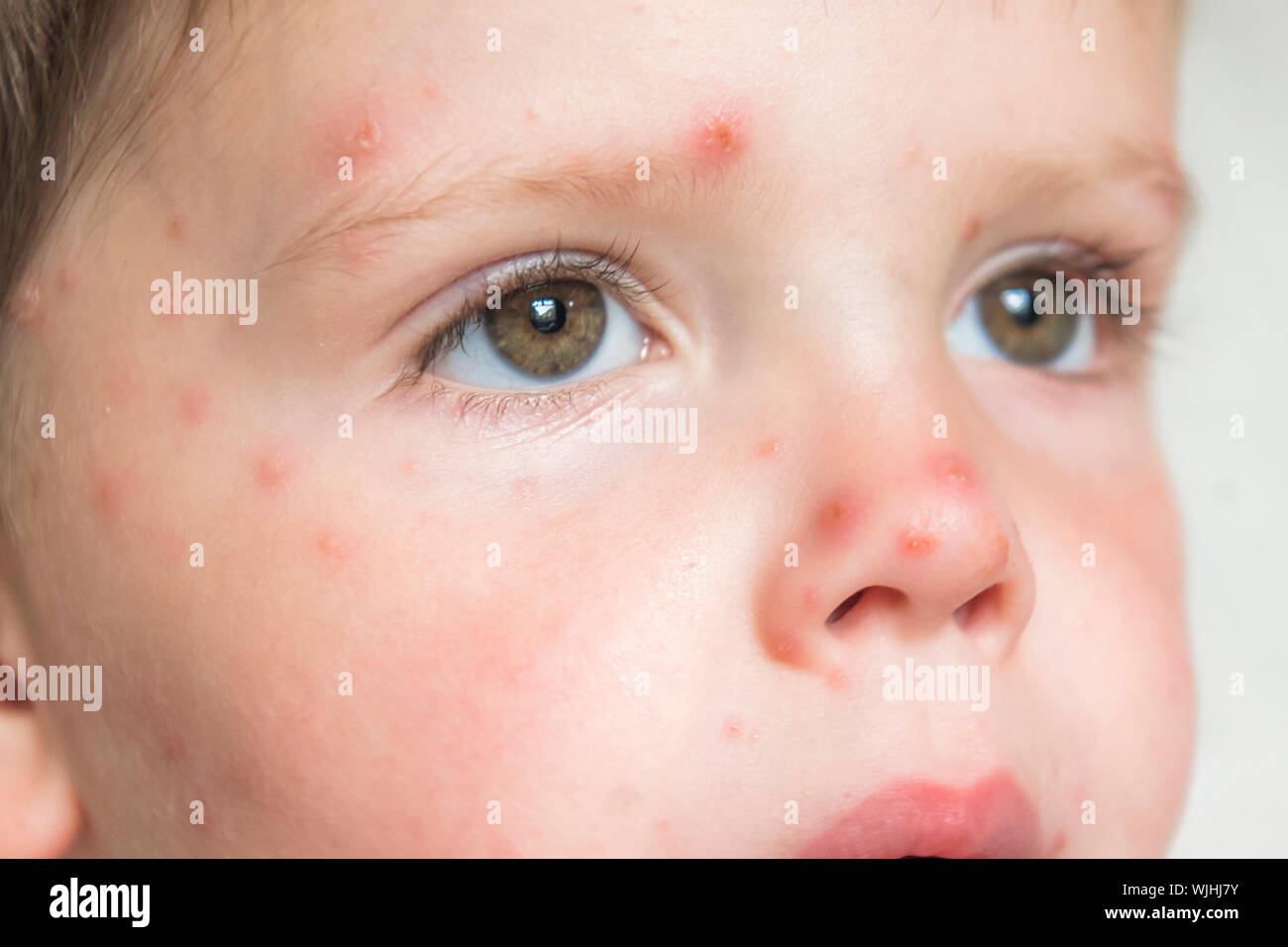 A two year old boy suffers from Chickenpox. also known as varicella ...