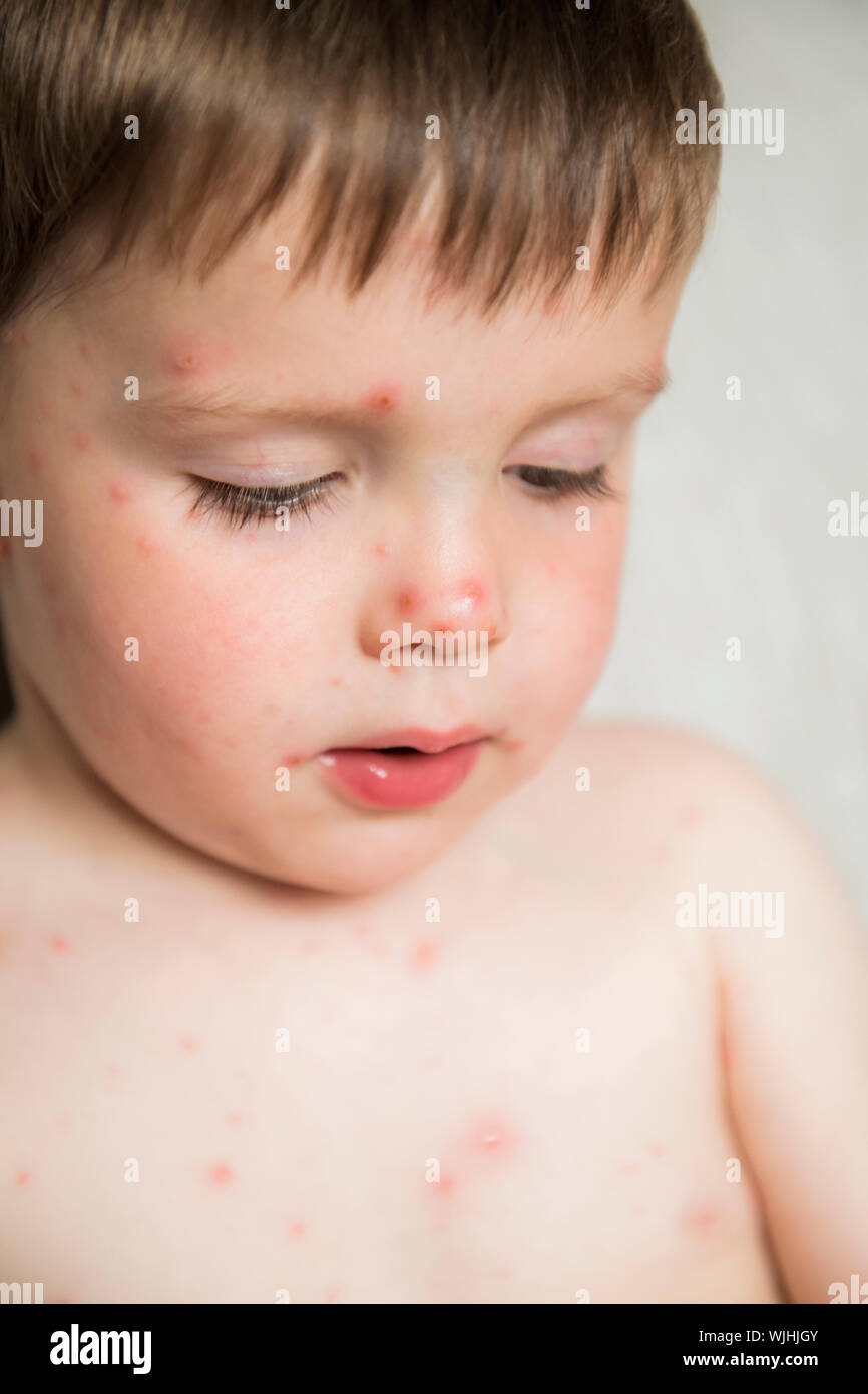 A two year old boy suffers from Chickenpox. also known as varicella ...