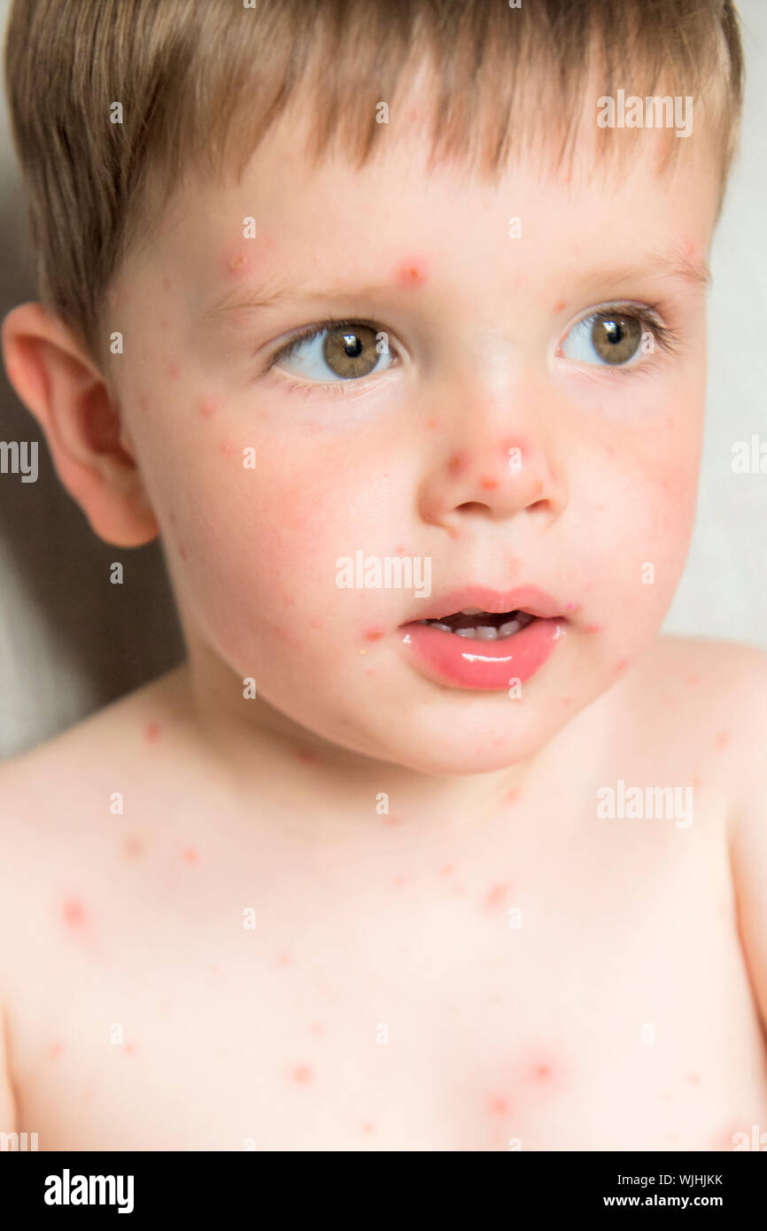 Chickenpox hi-res stock photography and images - Alamy