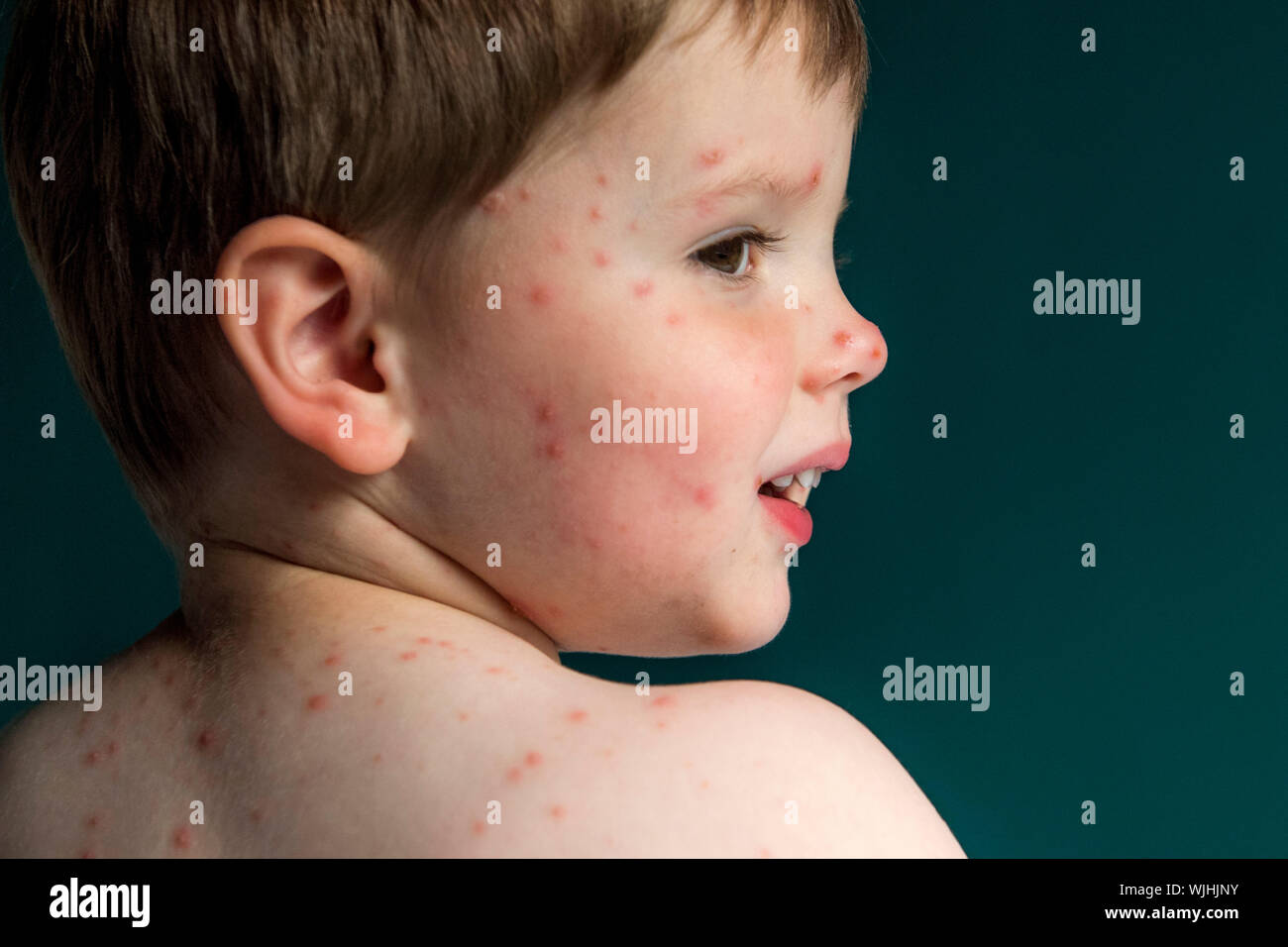 Scab scar hi-res stock photography and images - Alamy