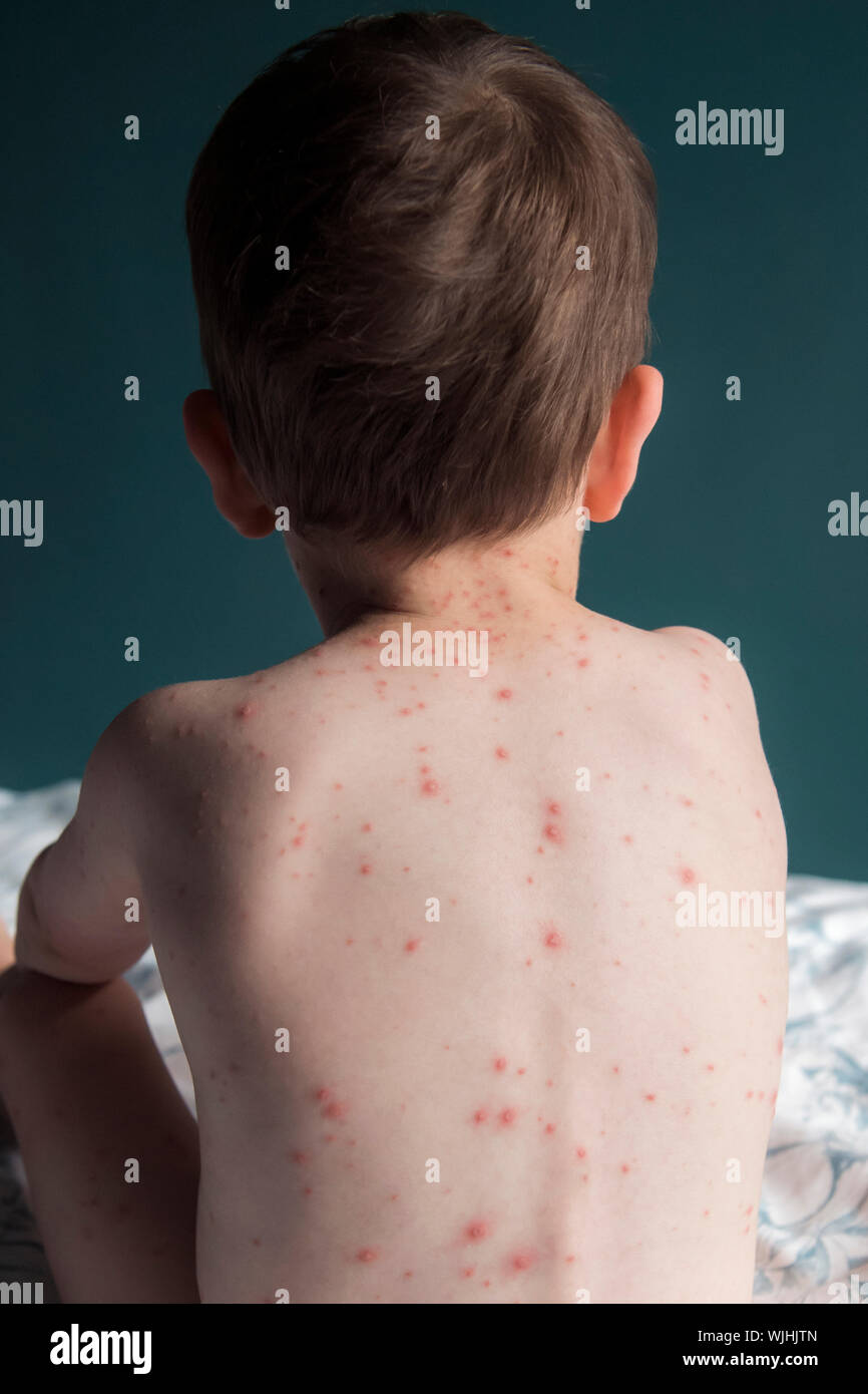 A two year old boy suffers from Chickenpox. also known as varicella ...