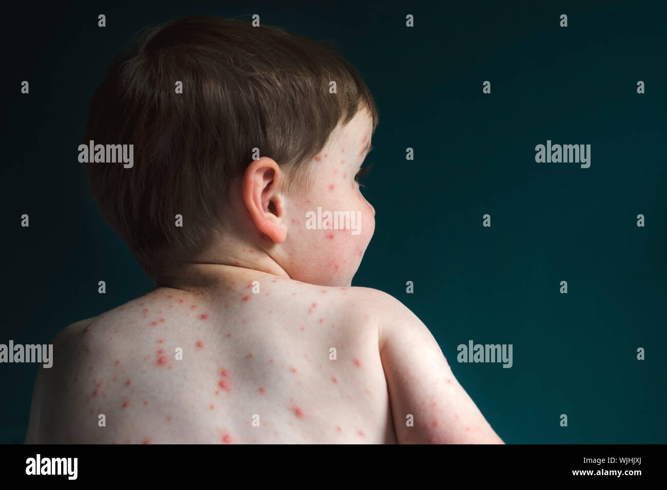 A two year old boy suffers from Chickenpox. also known as varicella ...