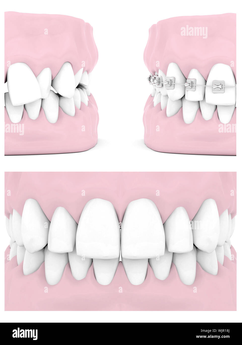 Dental braces isolated on white background Stock Photo - Alamy