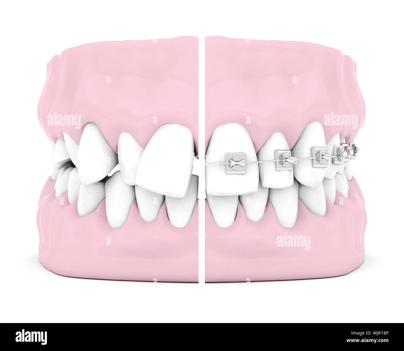 Dental braces isolated on white background Stock Photo - Alamy