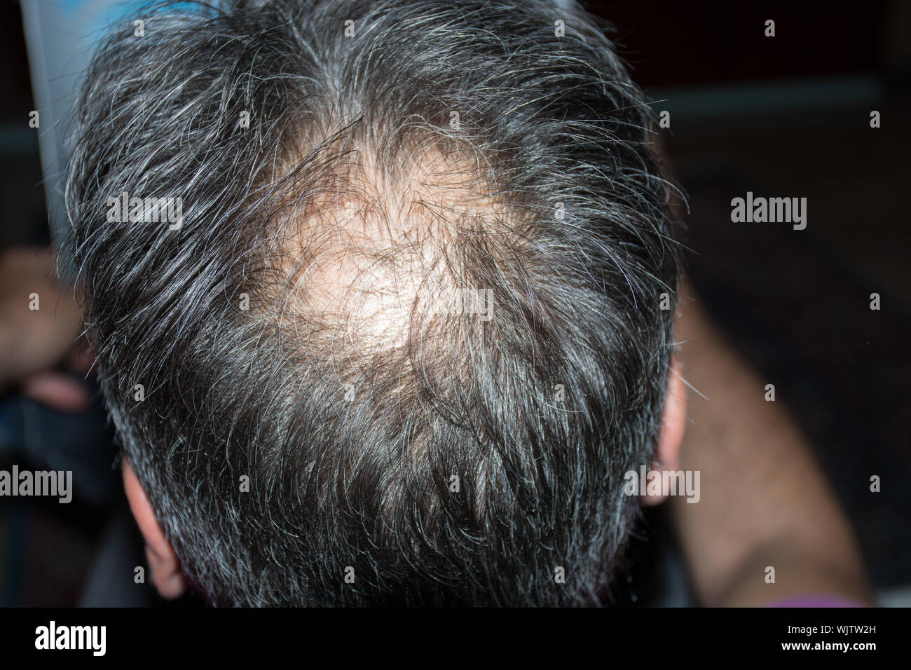 Balding Man Head Stock Photos & Balding Man Head Stock Images - Alamy
