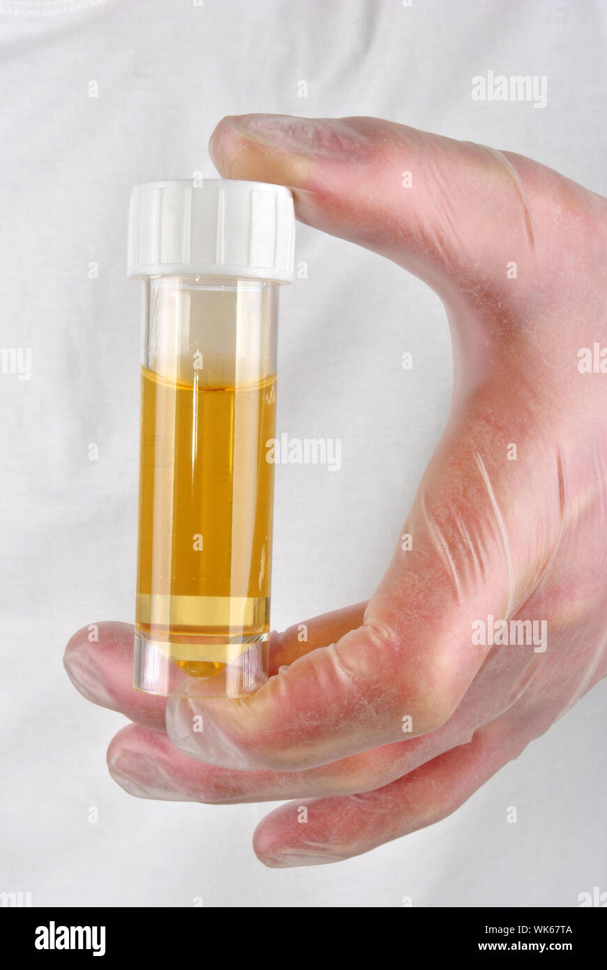 some human urine in a sample bottle Stock Photo - Alamy