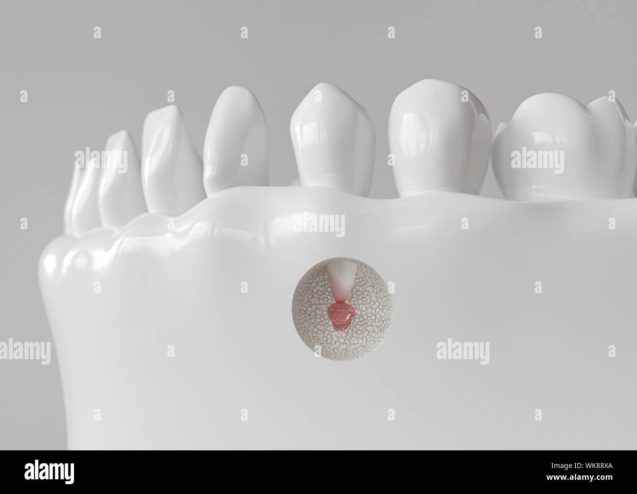 Root tip inflammation with apicectomy - 3D rendering Stock Photo - Alamy