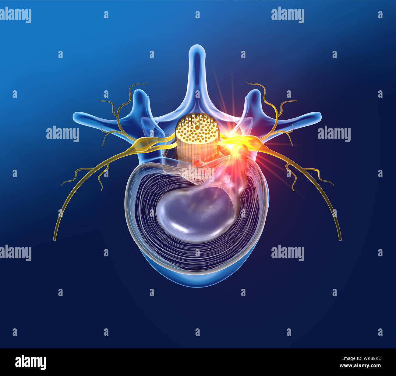 Illustration herniated spinal disk hi-res stock photography and images ...