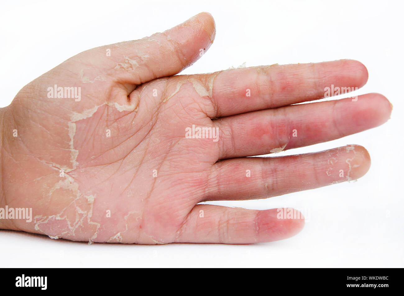 Skin condition hi-res stock photography and images - Alamy