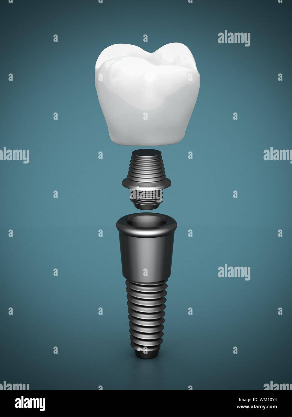 Dental implants on a beautiful blue background Stock Photo - Alamy