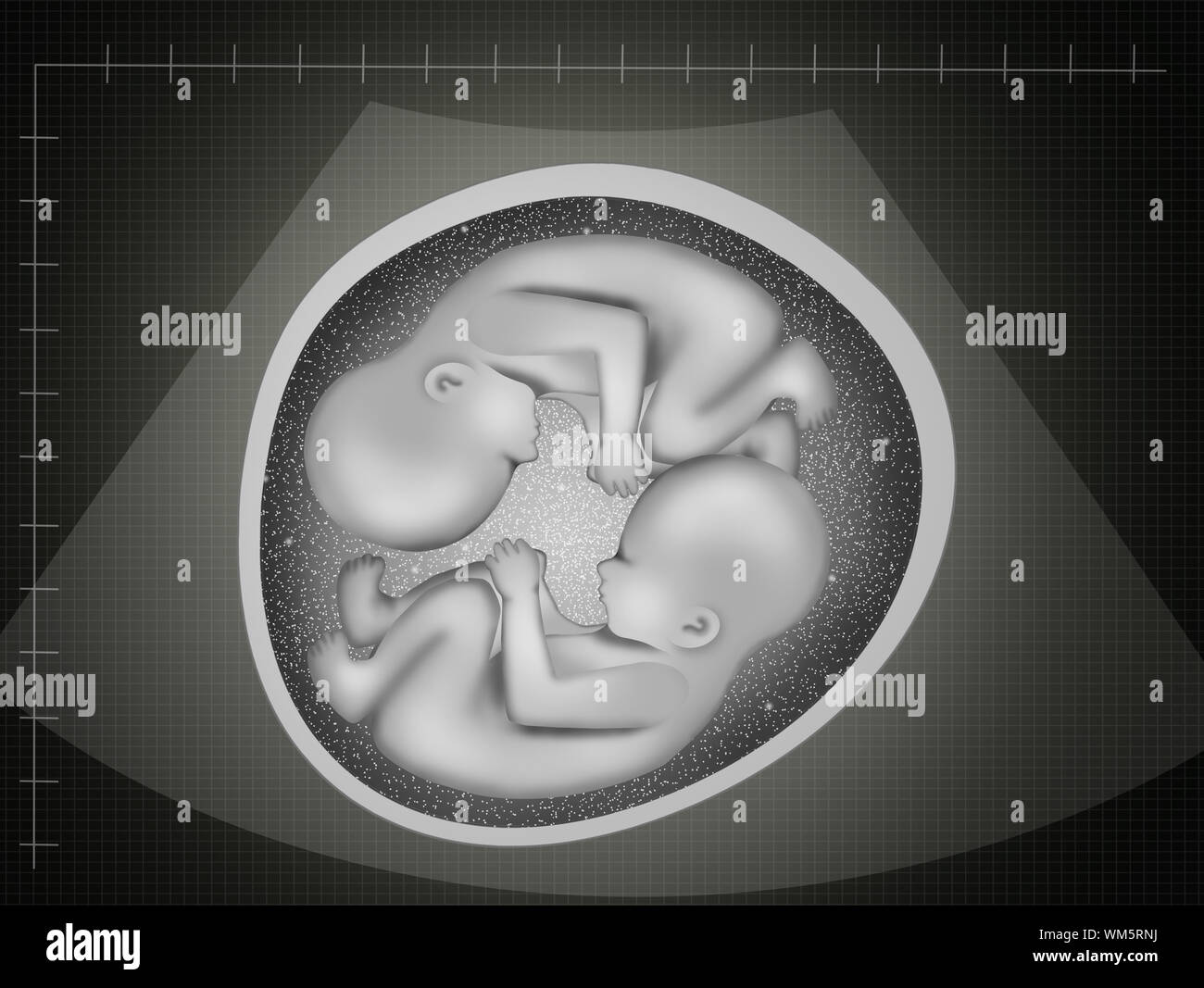 Fetus twins hi-res stock photography and images - Alamy