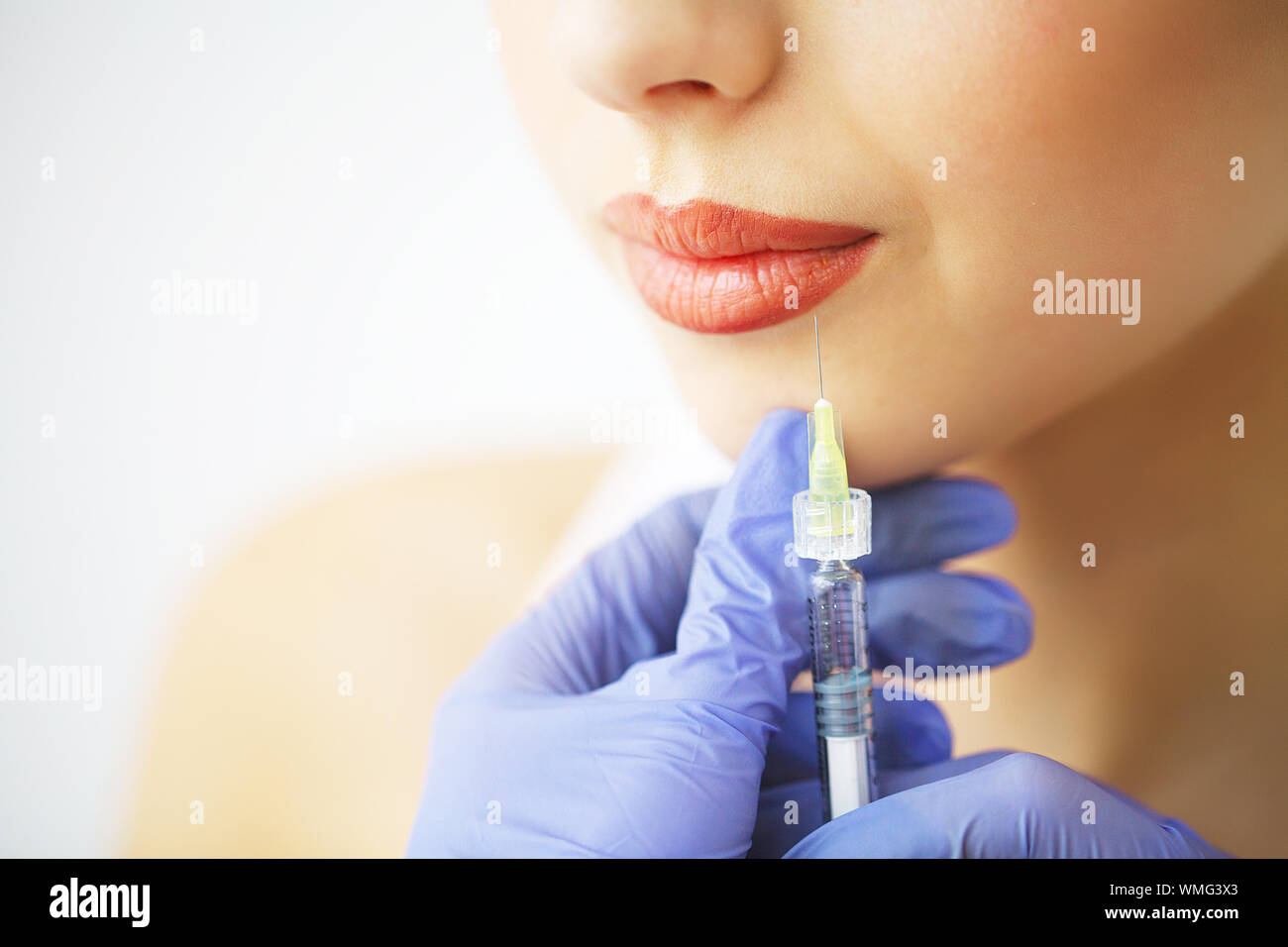 Lips plastic surgery injection on young woman face Stock Photo - Alamy