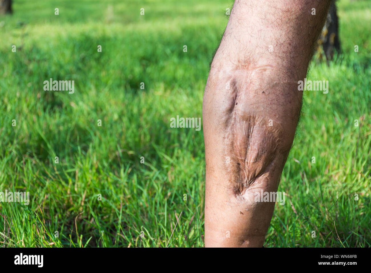 Injury stitches hi-res stock photography and images - Alamy