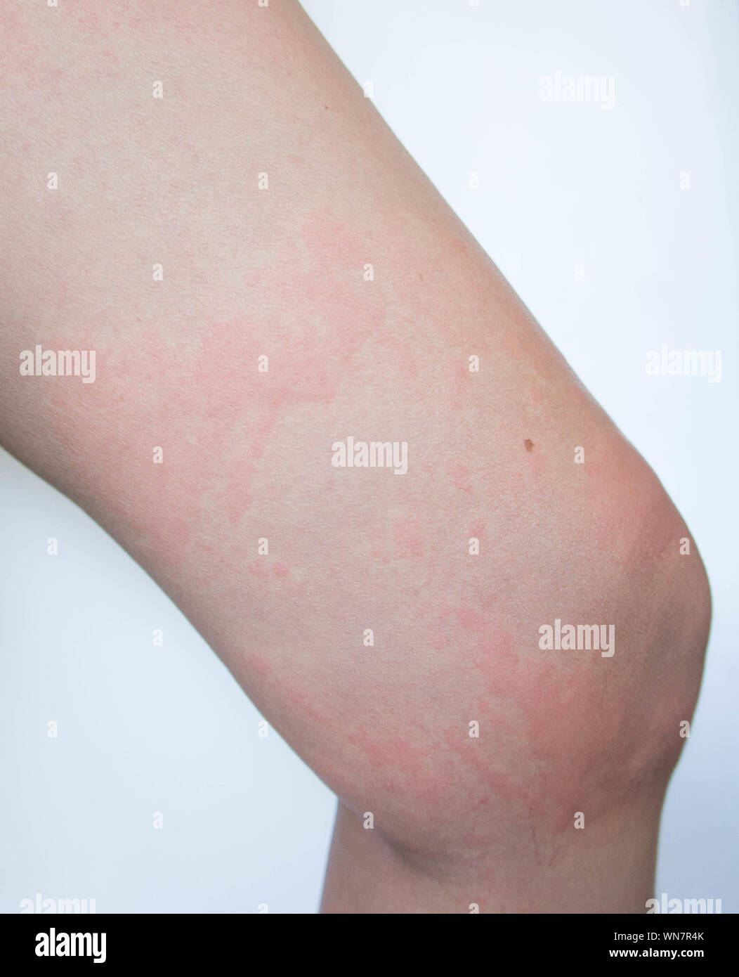 Skin Allergy High Resolution Stock Photography and Images - Alamy
