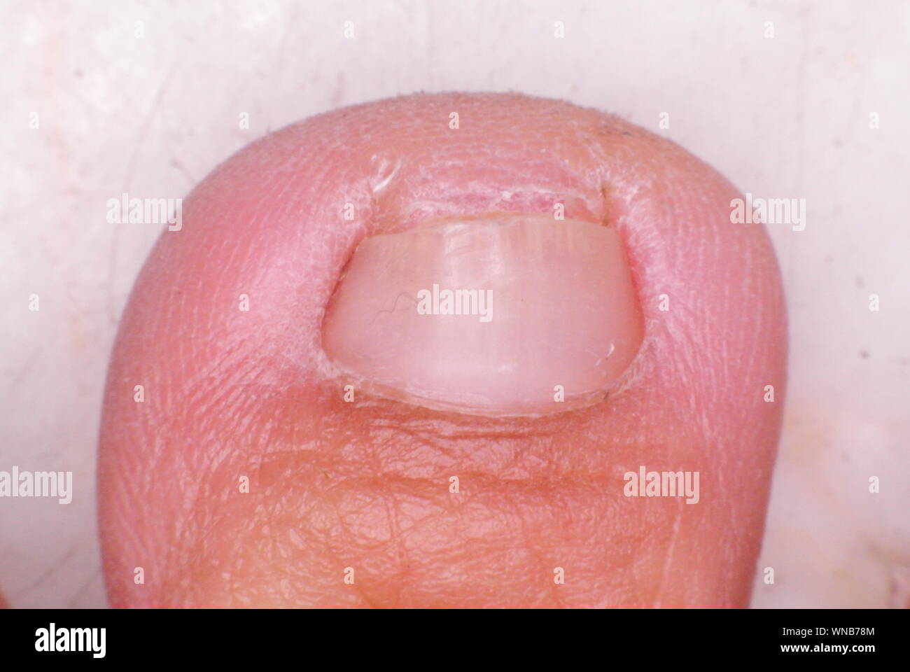 Human toenail hi-res stock photography and images - Alamy