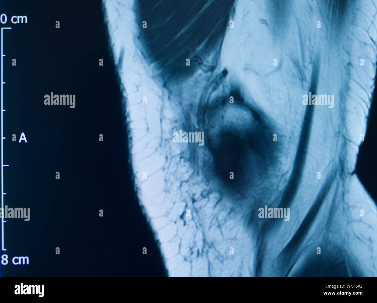 Knee sports injury mri mcl grade 2 tear magnetic resonance imaging ...