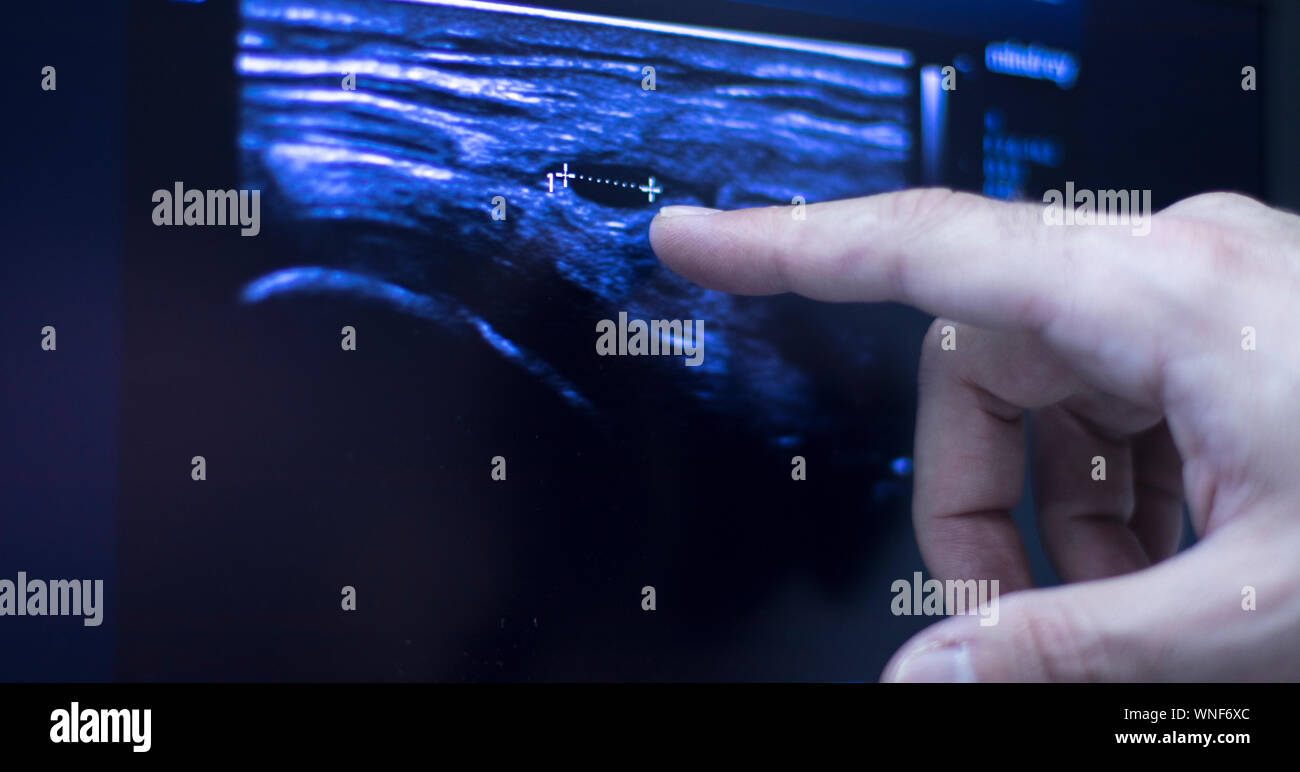 EPI Intratissue Percutaneous Electrolysis dry needling ultrasound ...