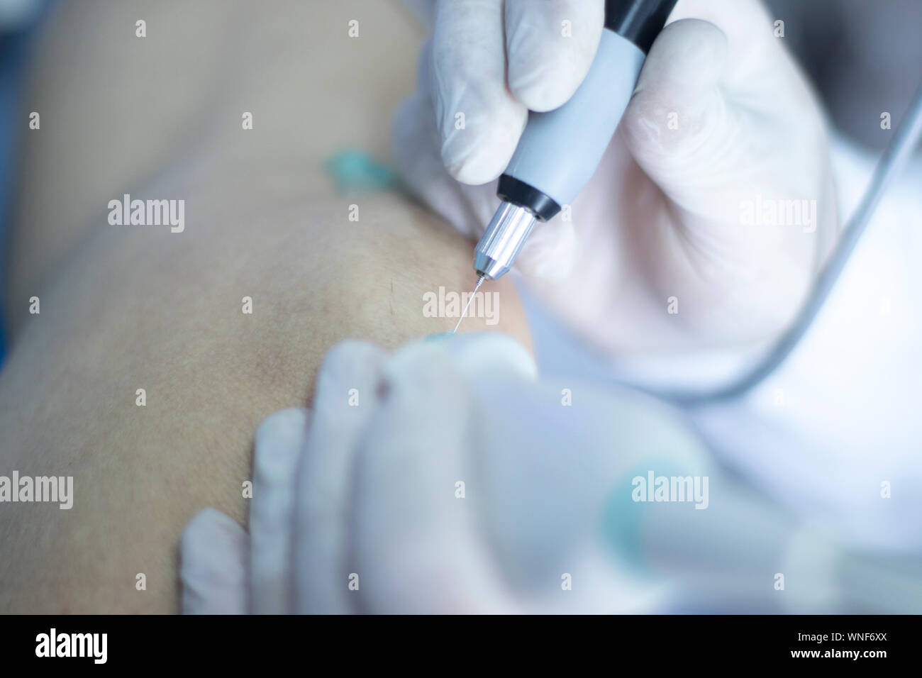 EPI Intratissue Percutaneous Electrolysis dry needling ultrasound ...