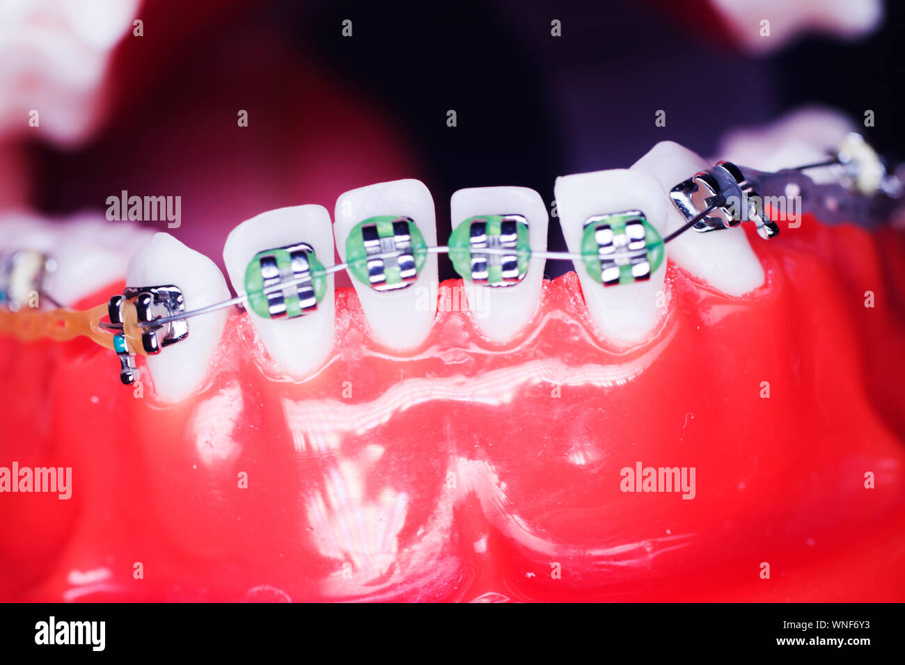 Modern metal retainers and plastic algners wire dental brackets teeth ...