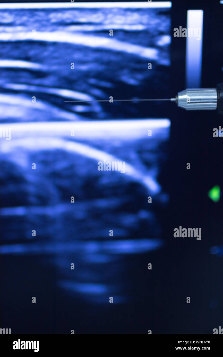 EPI Intratissue Percutaneous Electrolysis dry needling ultrasound ecography scan physiotherapy ...