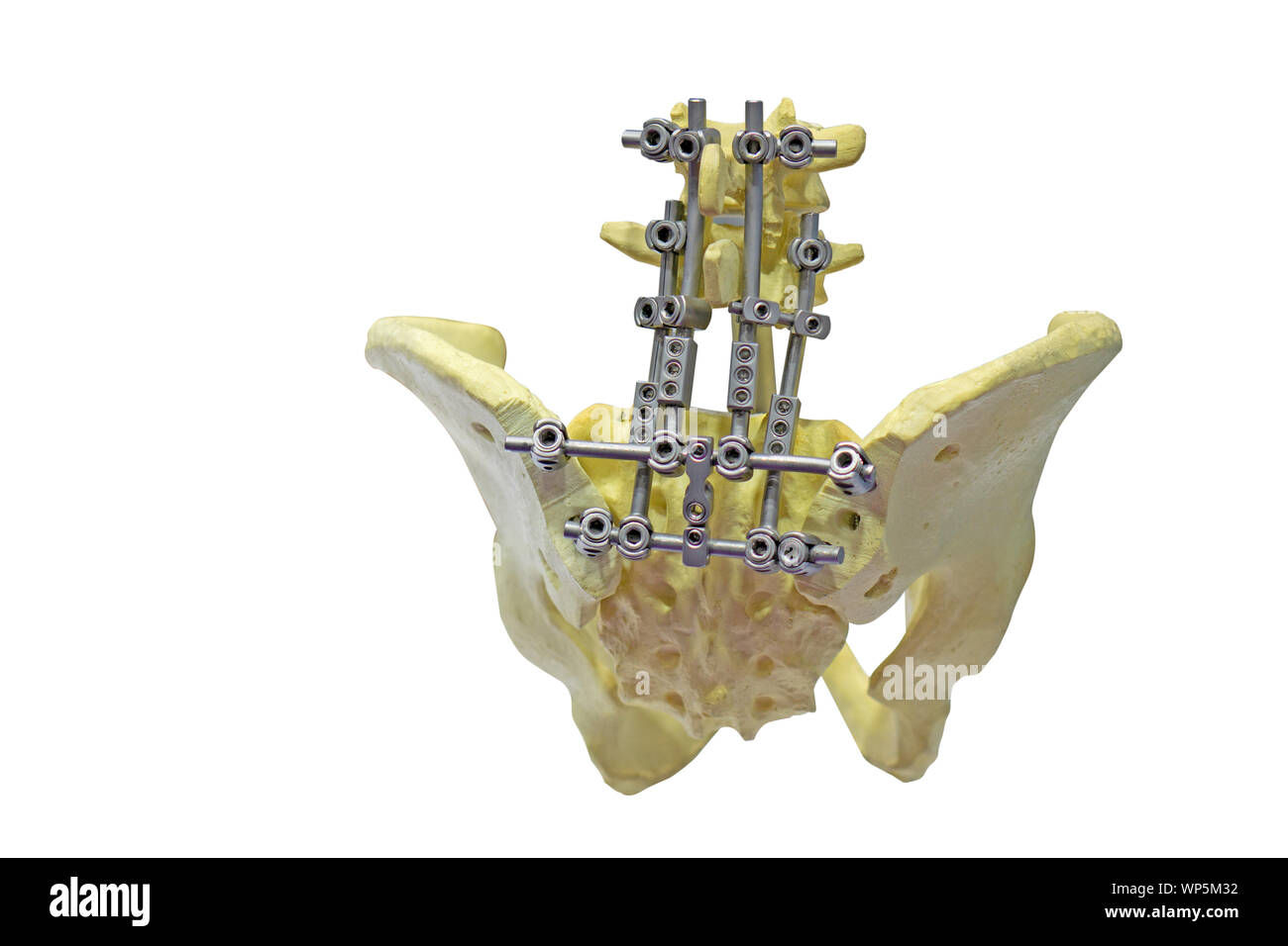 Treatment and repair of the pelvis or hip joint using an iron splint ...