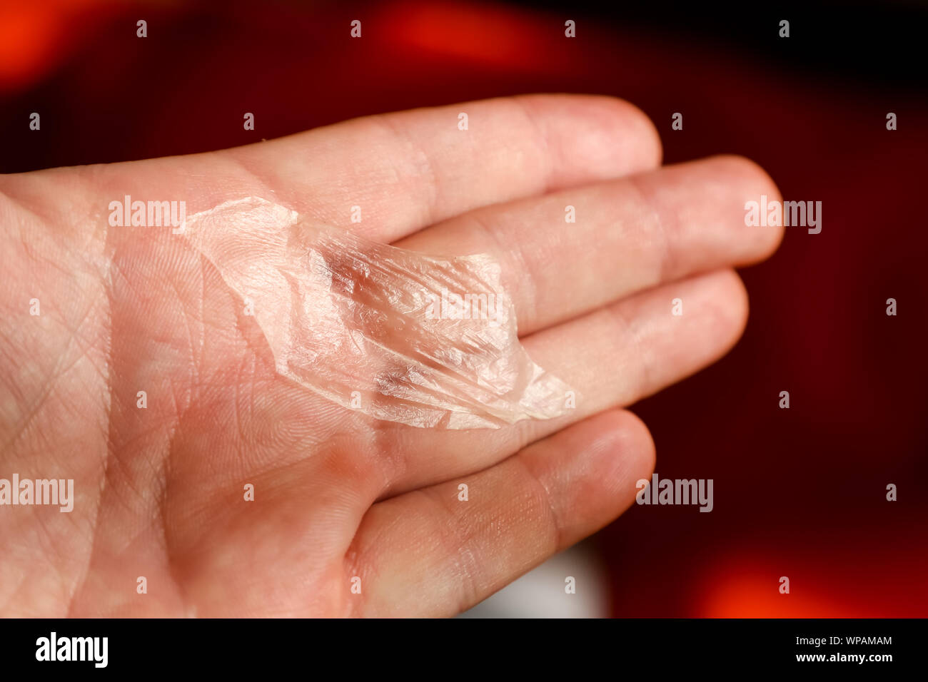 Peel burn hi-res stock photography and images - Alamy
