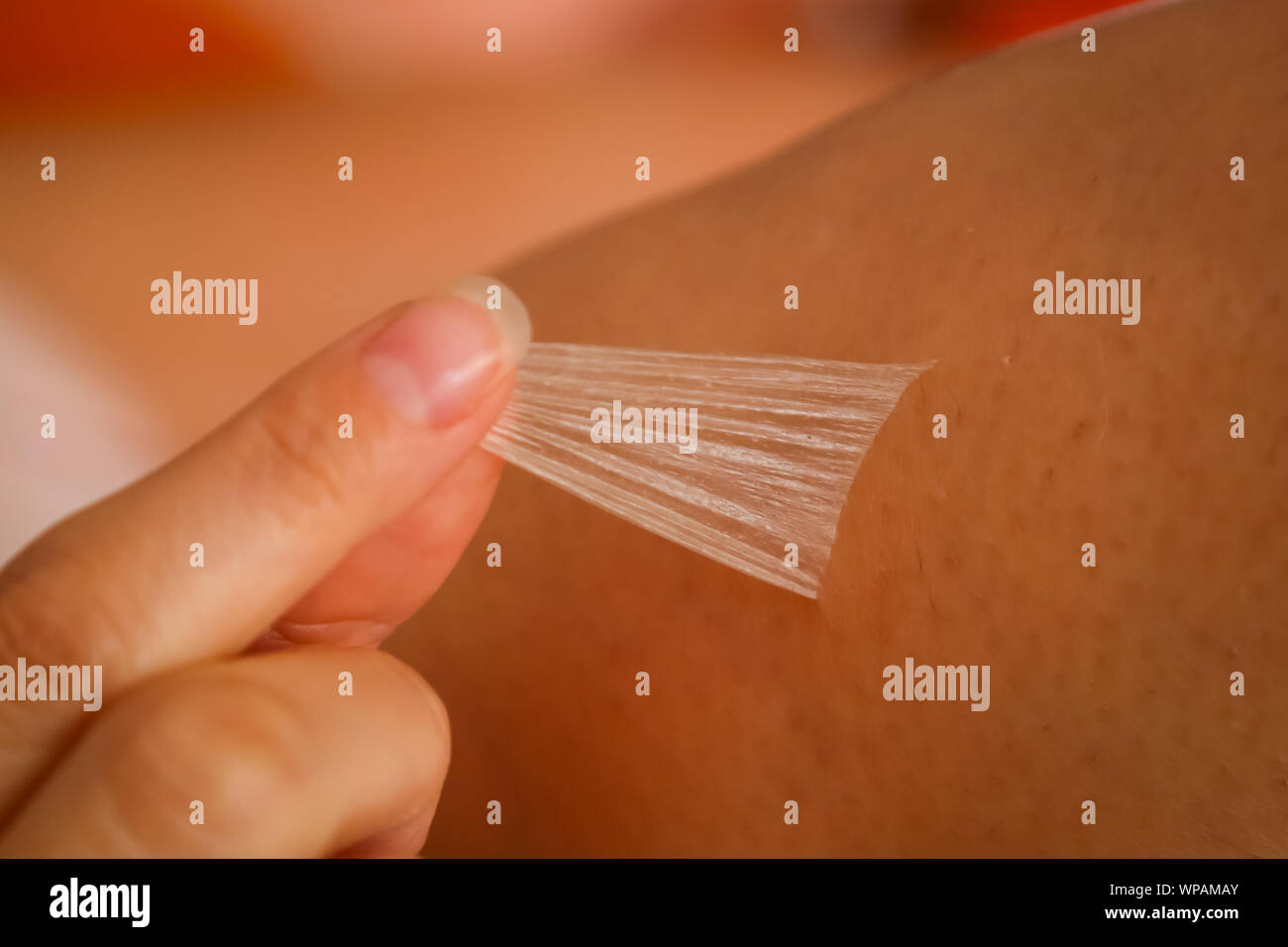 Detail of woman peeling her burned skin from the sun from her arm Stock ...