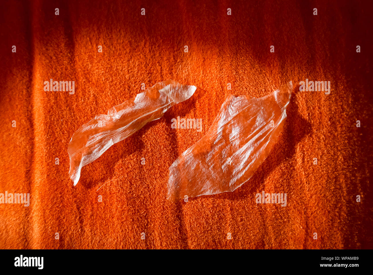 Detail of woman peeled burned skin from the sun from the arm on the ...
