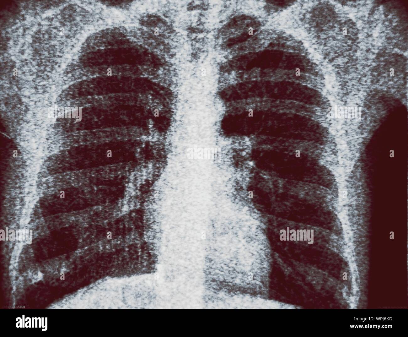 Chest ray hi-res stock photography and images - Alamy