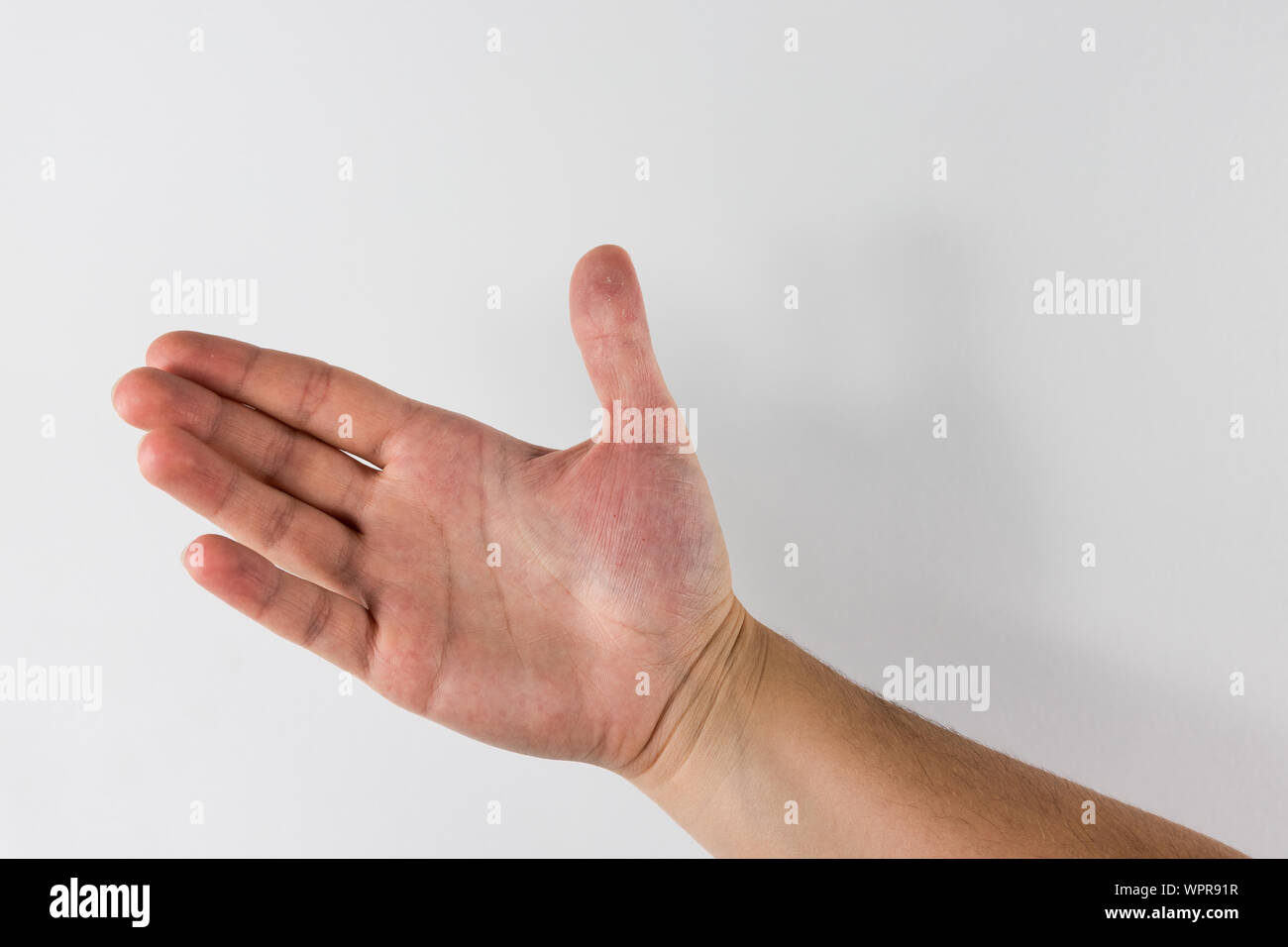 Eczema on the palm of the hand of a young girl, dry skin, itching ...