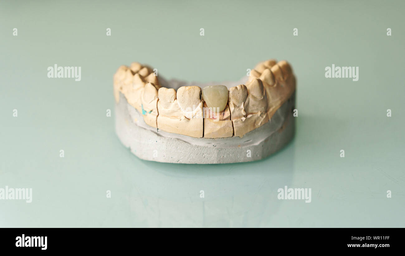 Cast of the lower jaw of a person. Installation of veneers. Dental ...