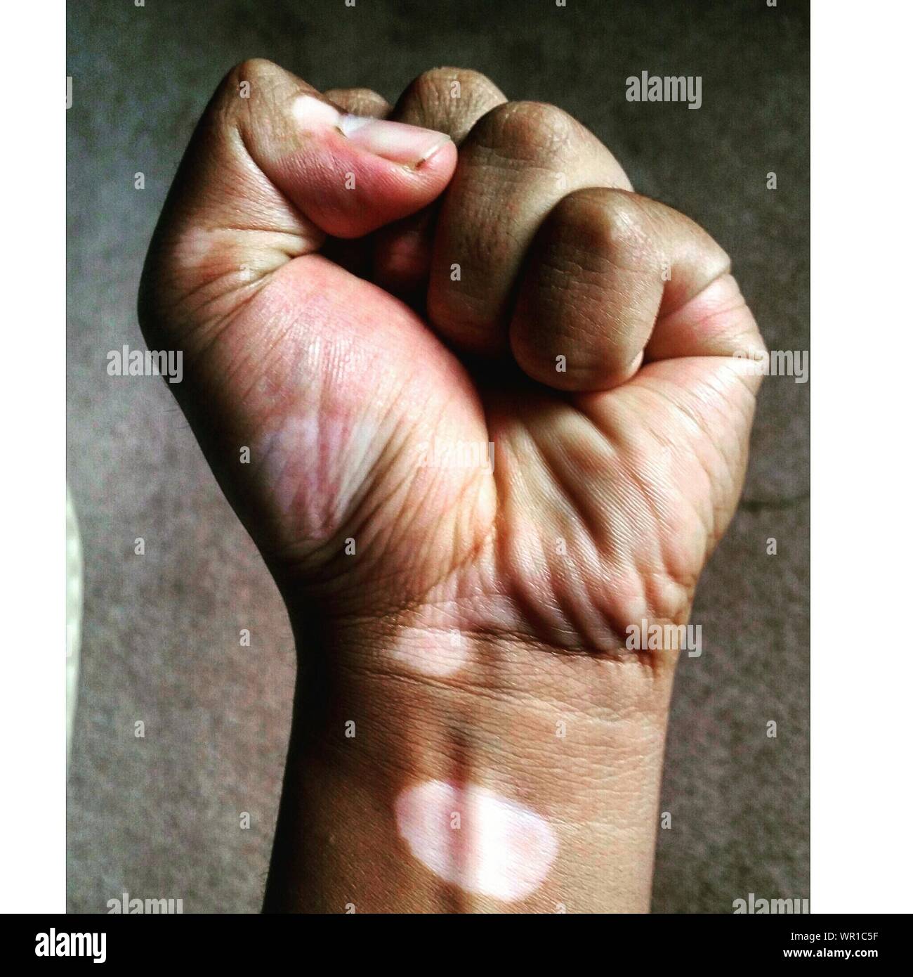 Vitiligo Skin Condition High Resolution Stock Photography and Images ...