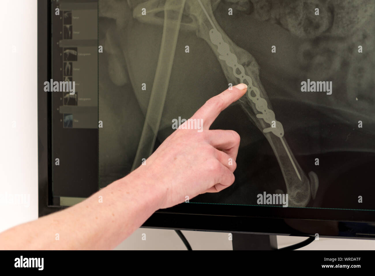 Ray leg after surgery hi-res stock photography and images - Alamy