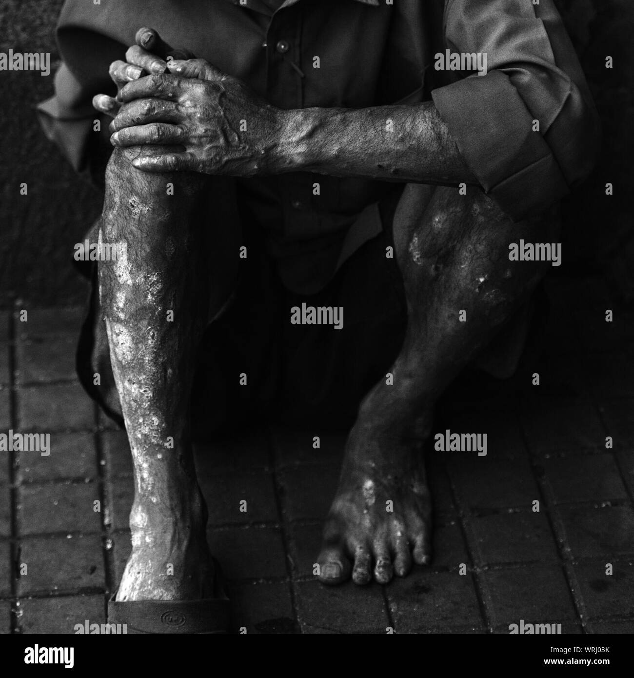 Man skin disease hi-res stock photography and images - Alamy
