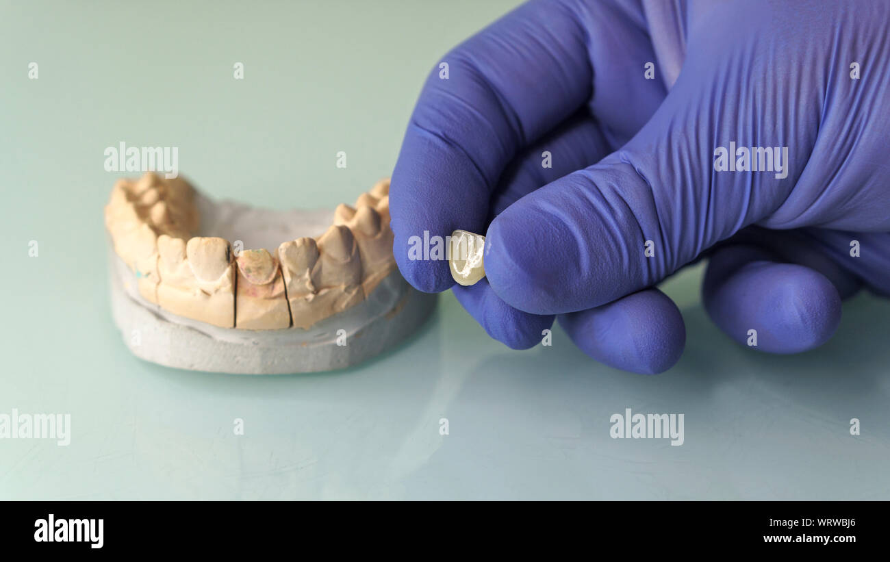 Cast of the lower jaw of a person. Dentist holds veneer. Dental ...