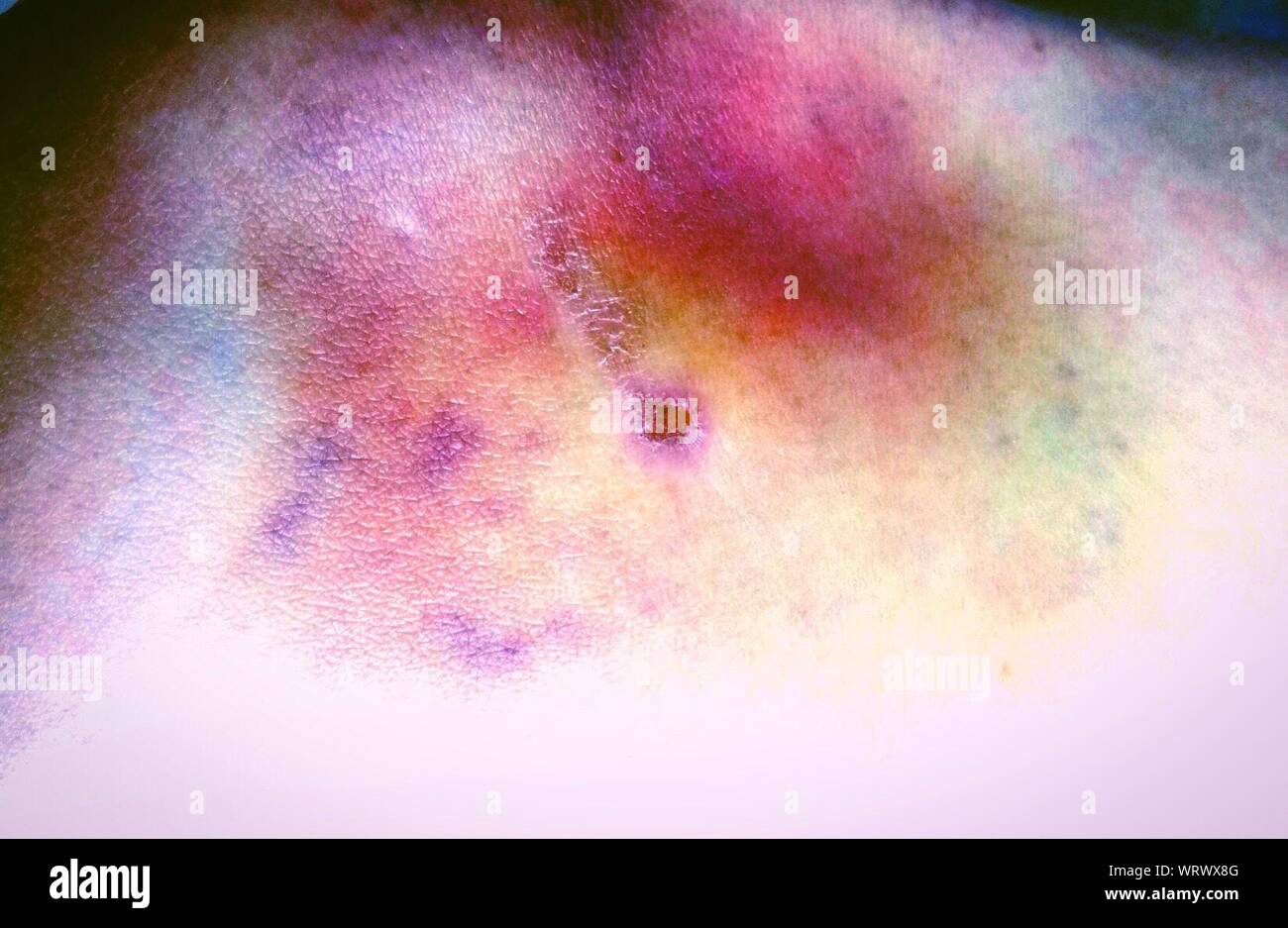 Bruised Skin High Resolution Stock Photography and Images - Alamy