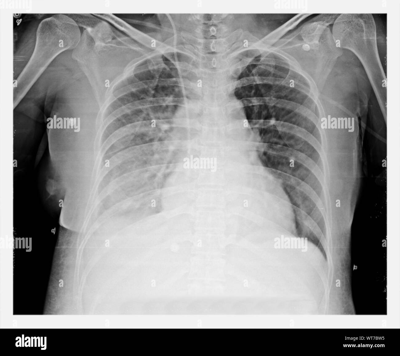 Chest X Ray High Resolution Stock Photography and Images - Alamy