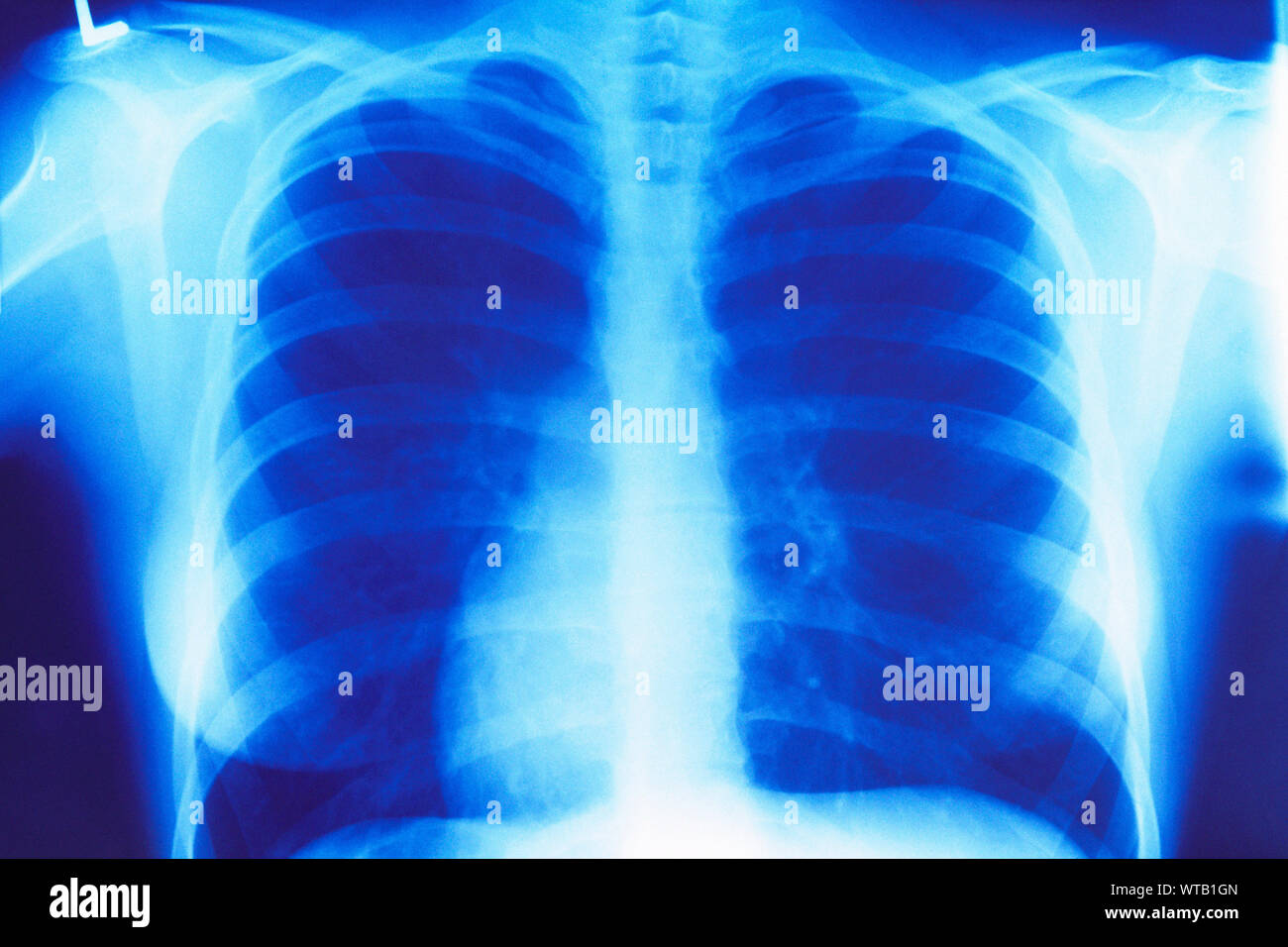 X-ray of a Human Torso Stock Photo - Alamy