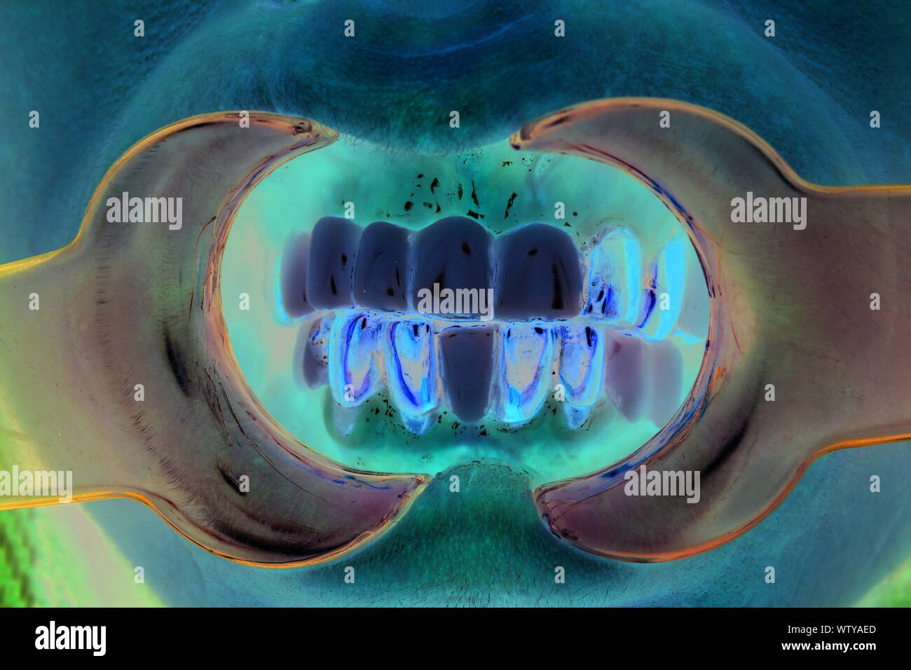 sick spoiled teeth of man close-up. Metal dental crowns, poor hygiene ...