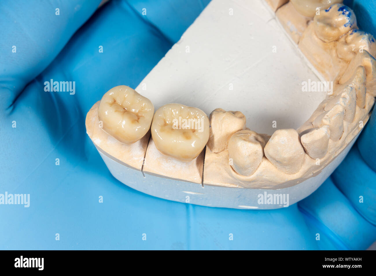 zirconium crowns of human teeth close-up in the hand of dentist doctor ...