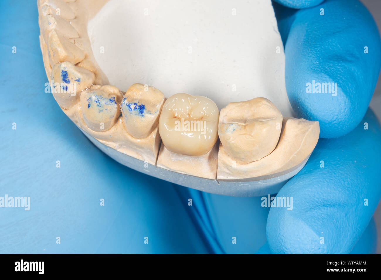 all-ceramic crowns of teeth close-up on plaster model of the jaw. Close ...