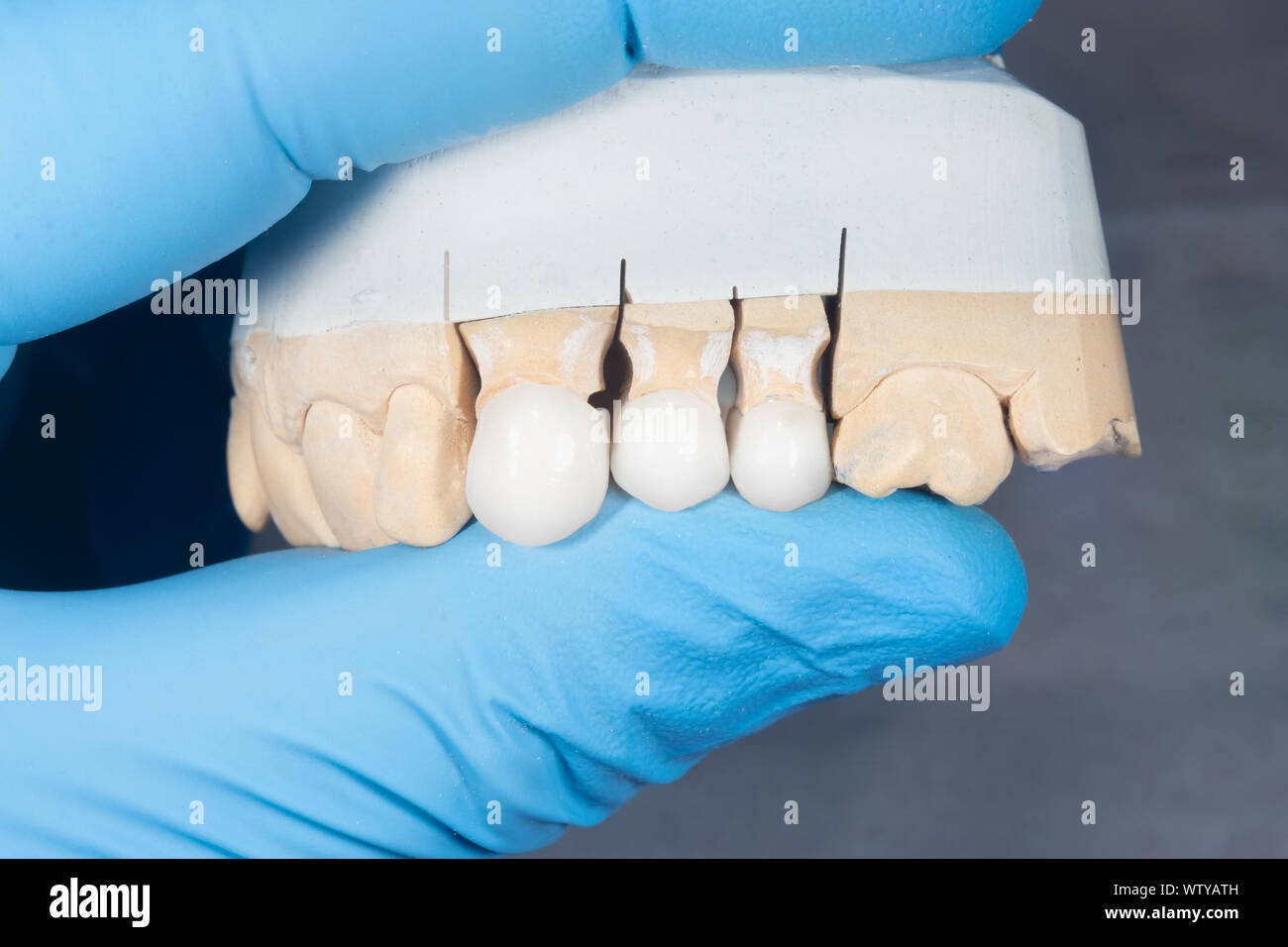 zirconium crowns of human teeth close-up in the hand of dentist doctor ...