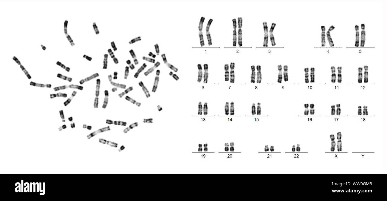 Karyotype hi-res stock photography and images - Alamy