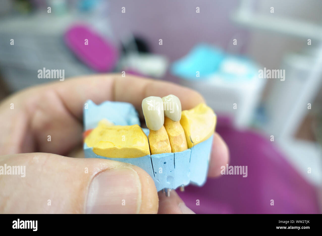 close-up ceramic tooth crown on a plaster model of teeth in the dentist ...