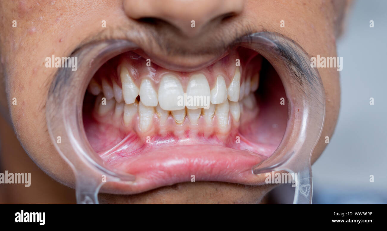 Woman dentist consultation checking hi-res stock photography and images ...