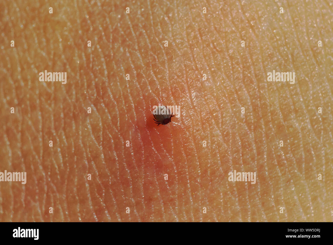 Small Ixodidae on human skin sucking blood. Tick parasit biting, macro ...