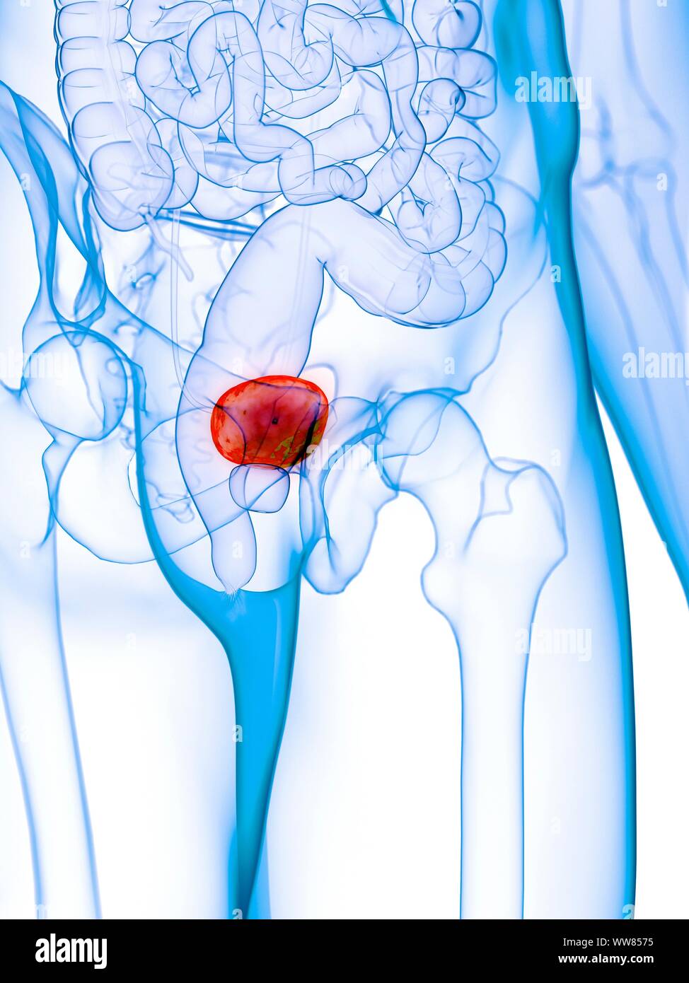 Diseased bladder, conceptual illustration Stock Photo - Alamy