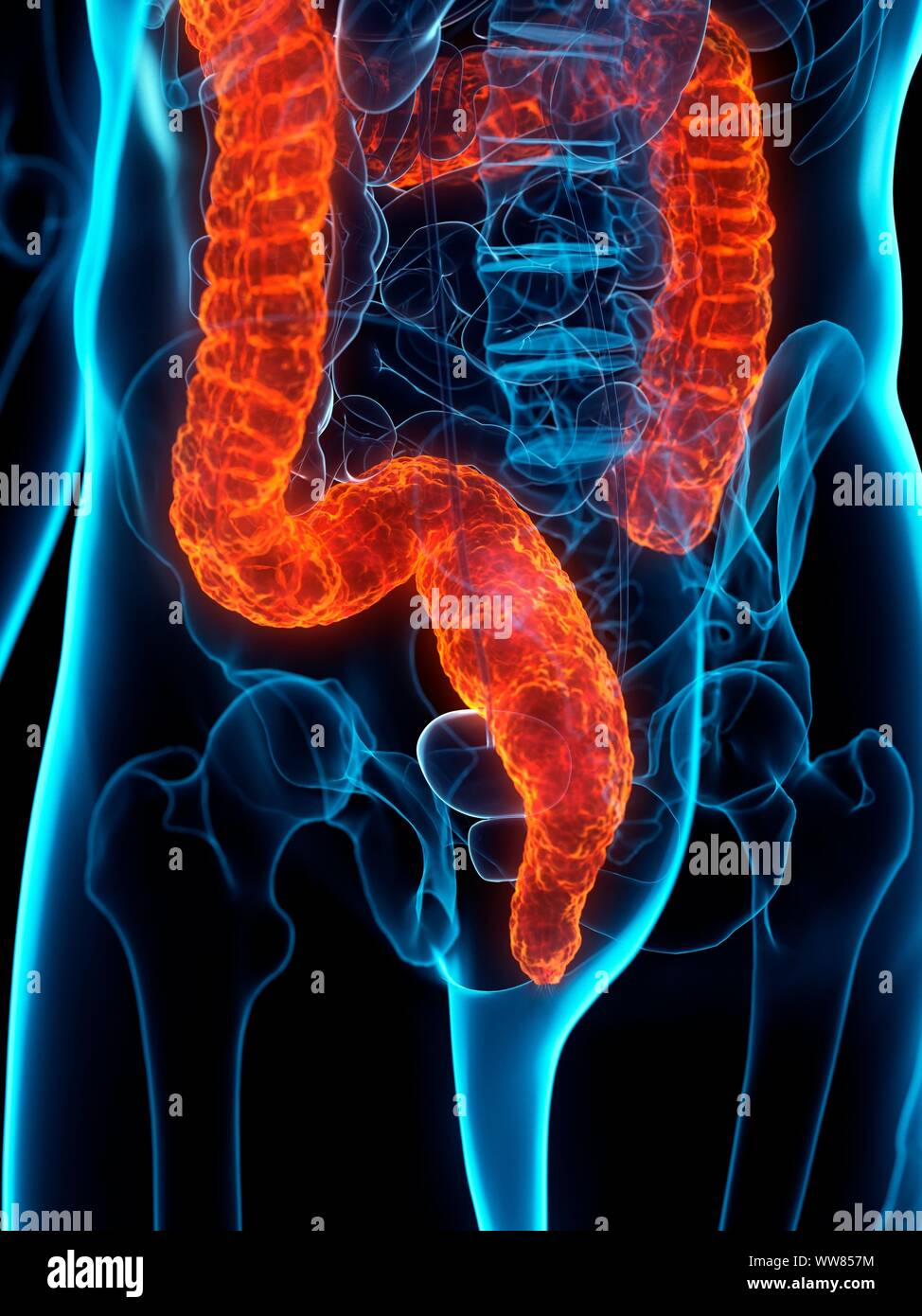 Diseased colon, conceptual illustration Stock Photo - Alamy