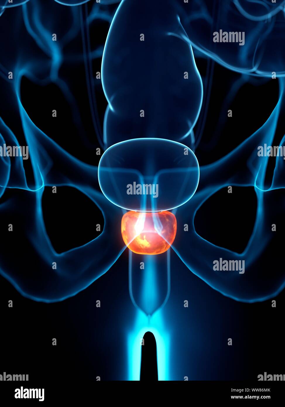 Inflamed prostate, illustration Stock Photo - Alamy